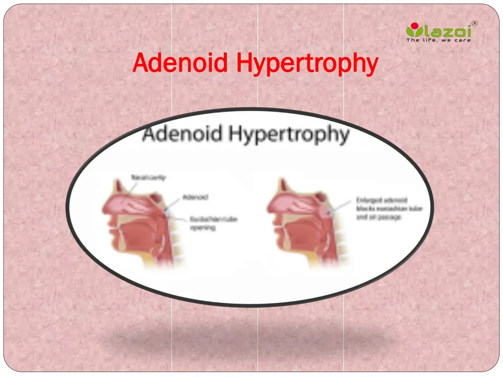 PPT - Adenoid Hypertrophy PowerPoint Presentation, free download - ID ...