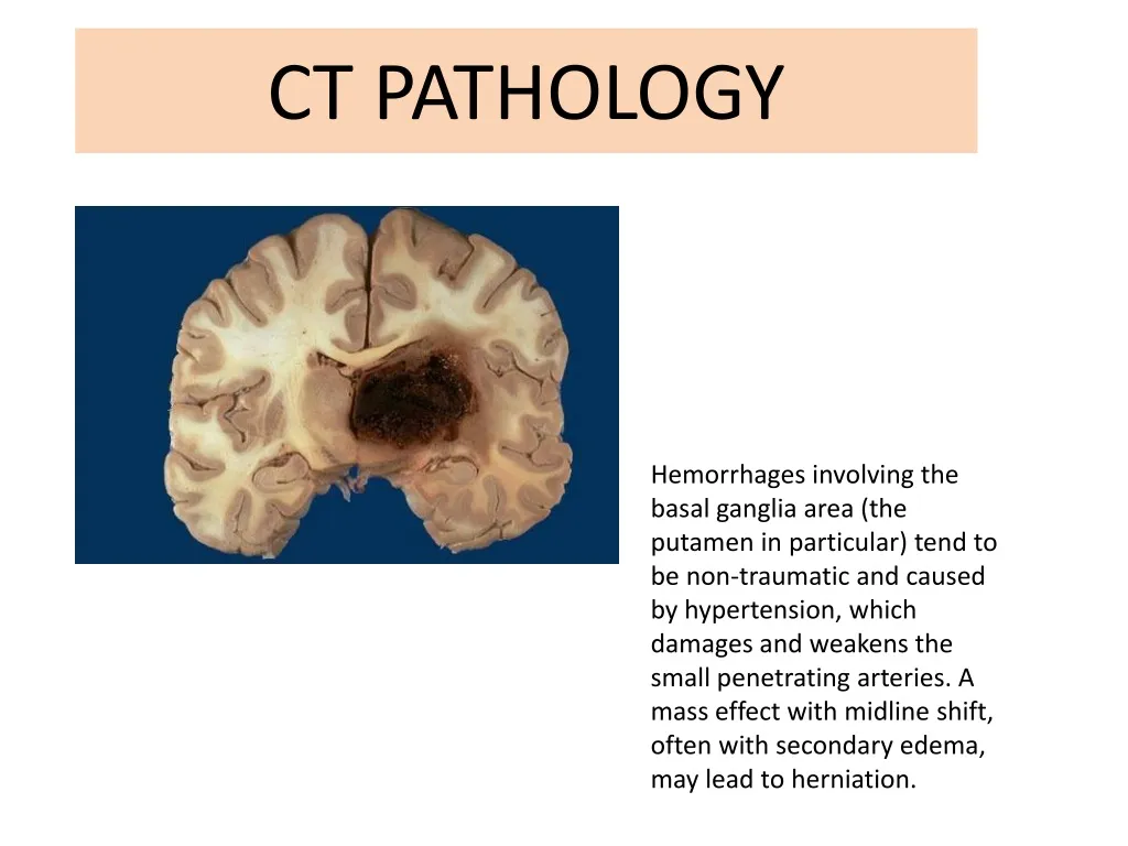 PPT - CT PATHOLOGY PowerPoint Presentation, free download - ID:154730