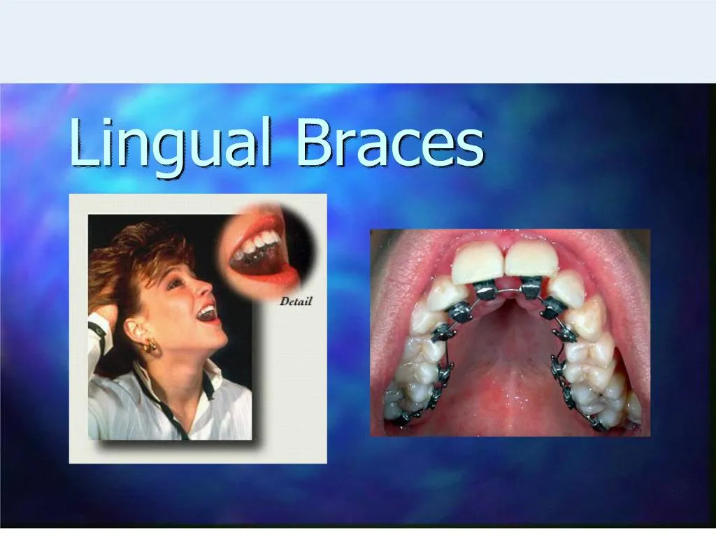 PPT - lingual braces PowerPoint Presentation, free download - ID:155888