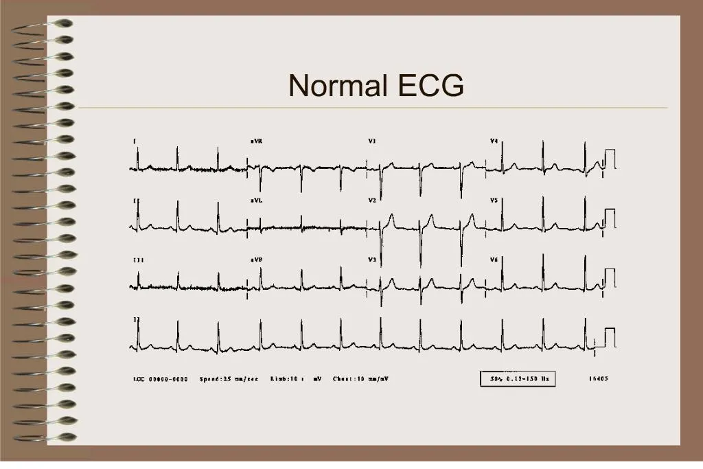 PPT - Normal ECG PowerPoint Presentation, free download - ID:175743