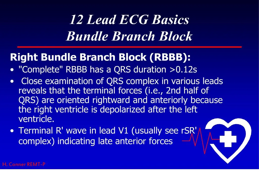 PPT - 12 Lead ECG Basics Bundle Branch Block PowerPoint Presentation ...