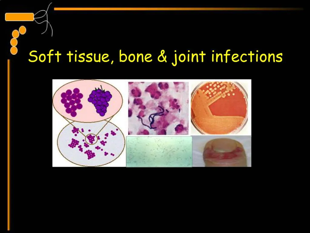 PPT - Soft tissue, bone joint infections PowerPoint Presentation, free download - ID:308702