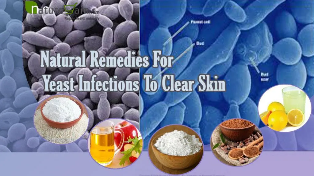 PPT - Natural Remedies For Yeast Infections To Clear Infections ...