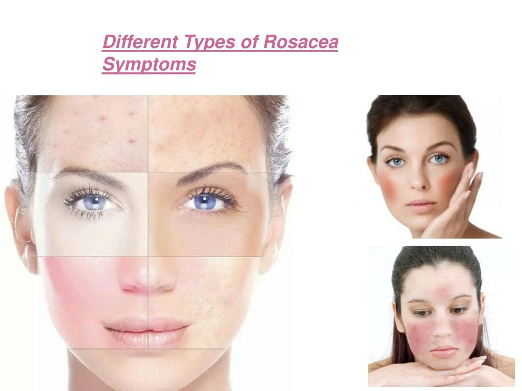 PPT - Different Types of Rosacea Symptoms PowerPoint Presentation, free ...