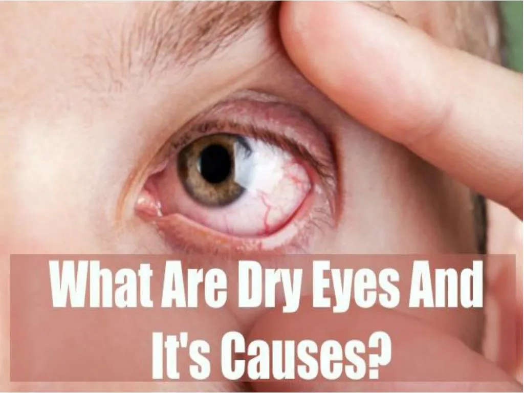 PPT - What are Dry eyes and it's causes? PowerPoint Presentation, free ...