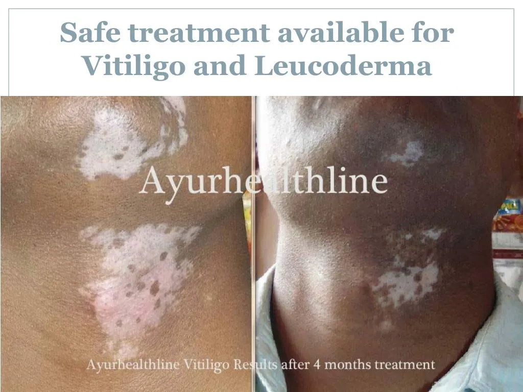 PPT - Safe treatment available for Vitiligo and Leucoderma PowerPoint ...
