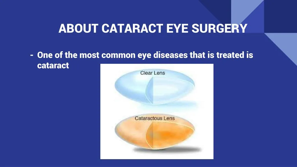 PPT - ABOUT CATARACT EYE SURGERY PowerPoint Presentation, free download ...