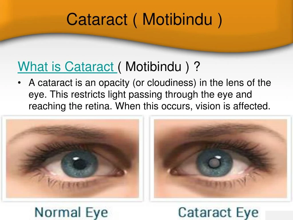 PPT - Cataract surgery-Asian Eye Hospital PowerPoint Presentation - ID ...
