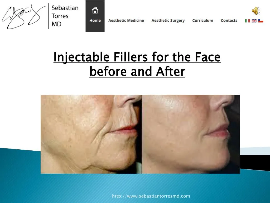 PPT - Injectable Fillers for The Face Before and After PowerPoint ...