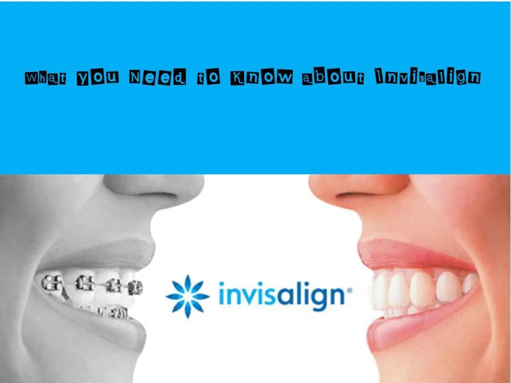 PPT - What you Need to Know about Invisalign PowerPoint Presentation ...