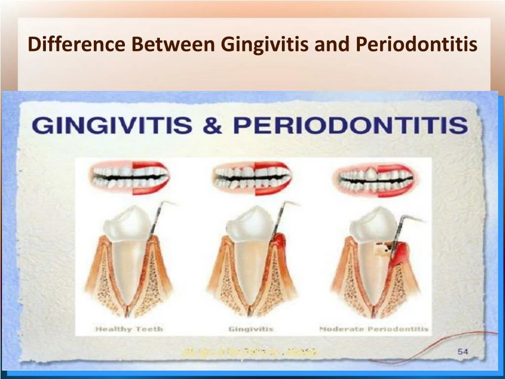 PPT - Tips & Understanding The Symptoms of Gingivitis PowerPoint ...