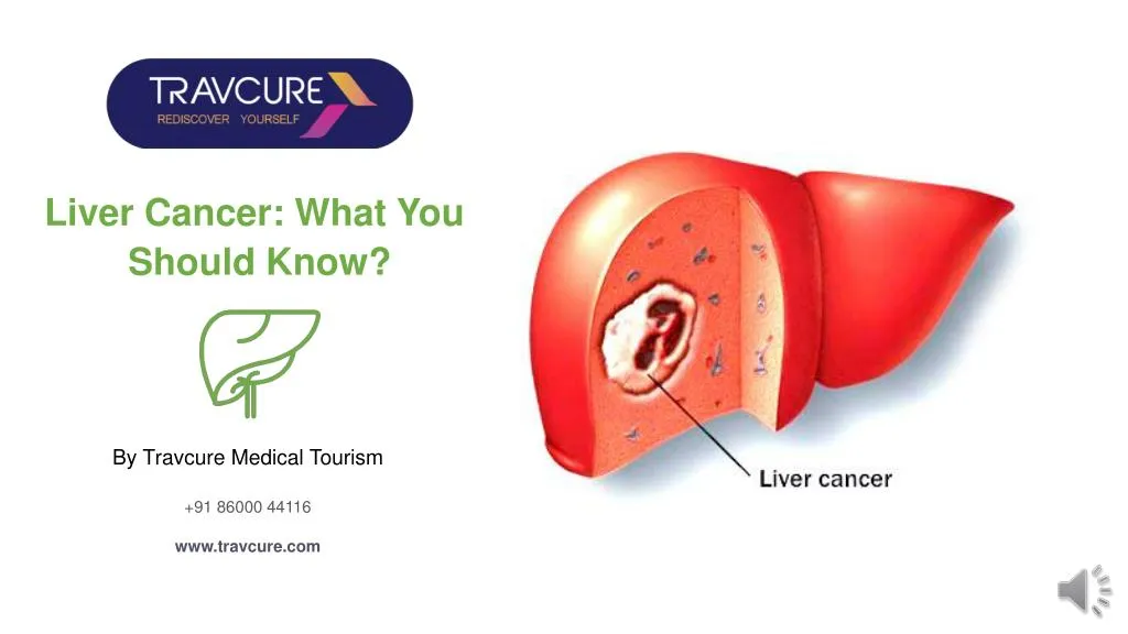 PPT - Liver Cancer: What You Should Know PowerPoint Presentation, free ...