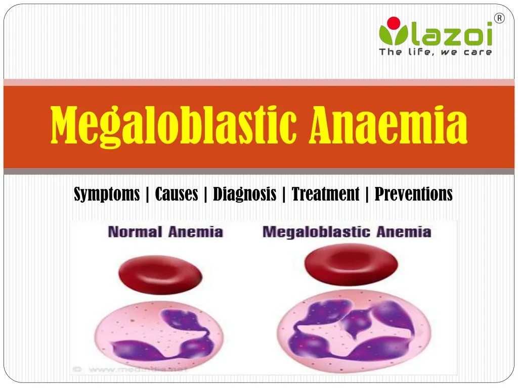 PPT - Megaloblastic Anaemia: Symptoms, causes, diagnosis, treatment and ...