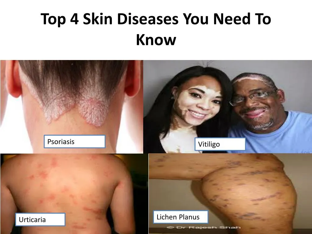 PPT - Top 4 skin diseases you need to know PowerPoint Presentation ...