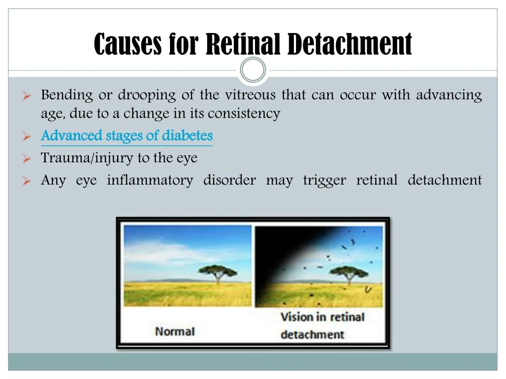 PPT - Retinal Detachment: Causes, Symptoms, Diagnosis and Treatment ...