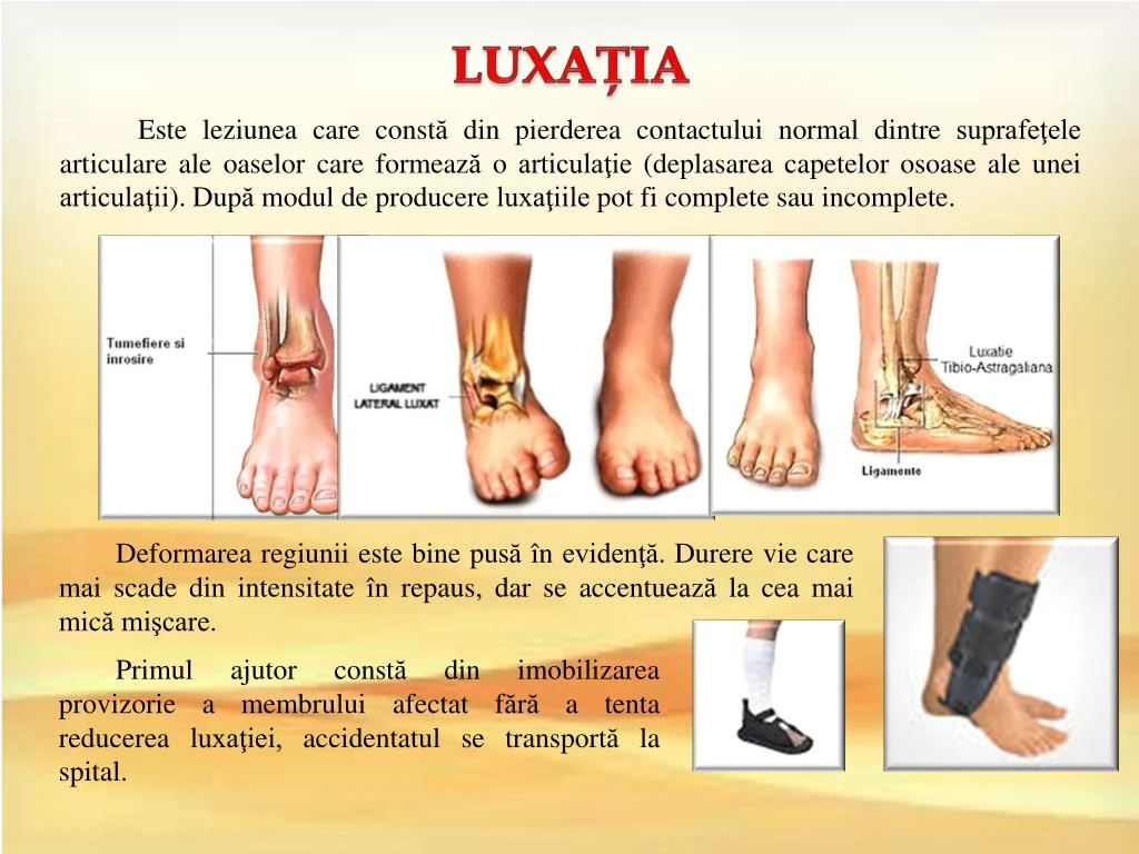 PPT - ENTORSE, LUXATII, FRACTURI PowerPoint Presentation - ID:7498793