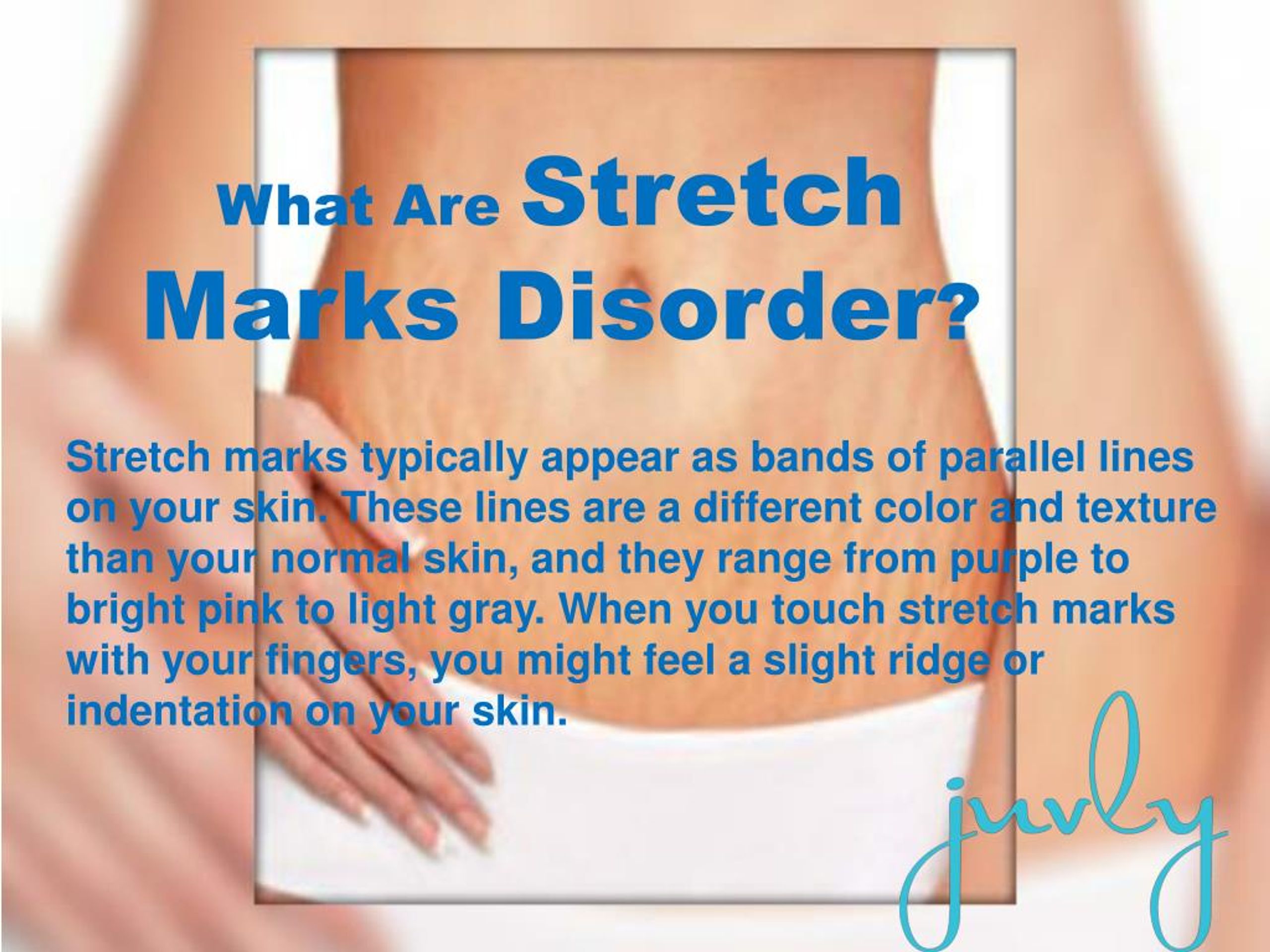PPT - Laser Stretch Marks Removal Treatment | Stretch Mark Therapy ...