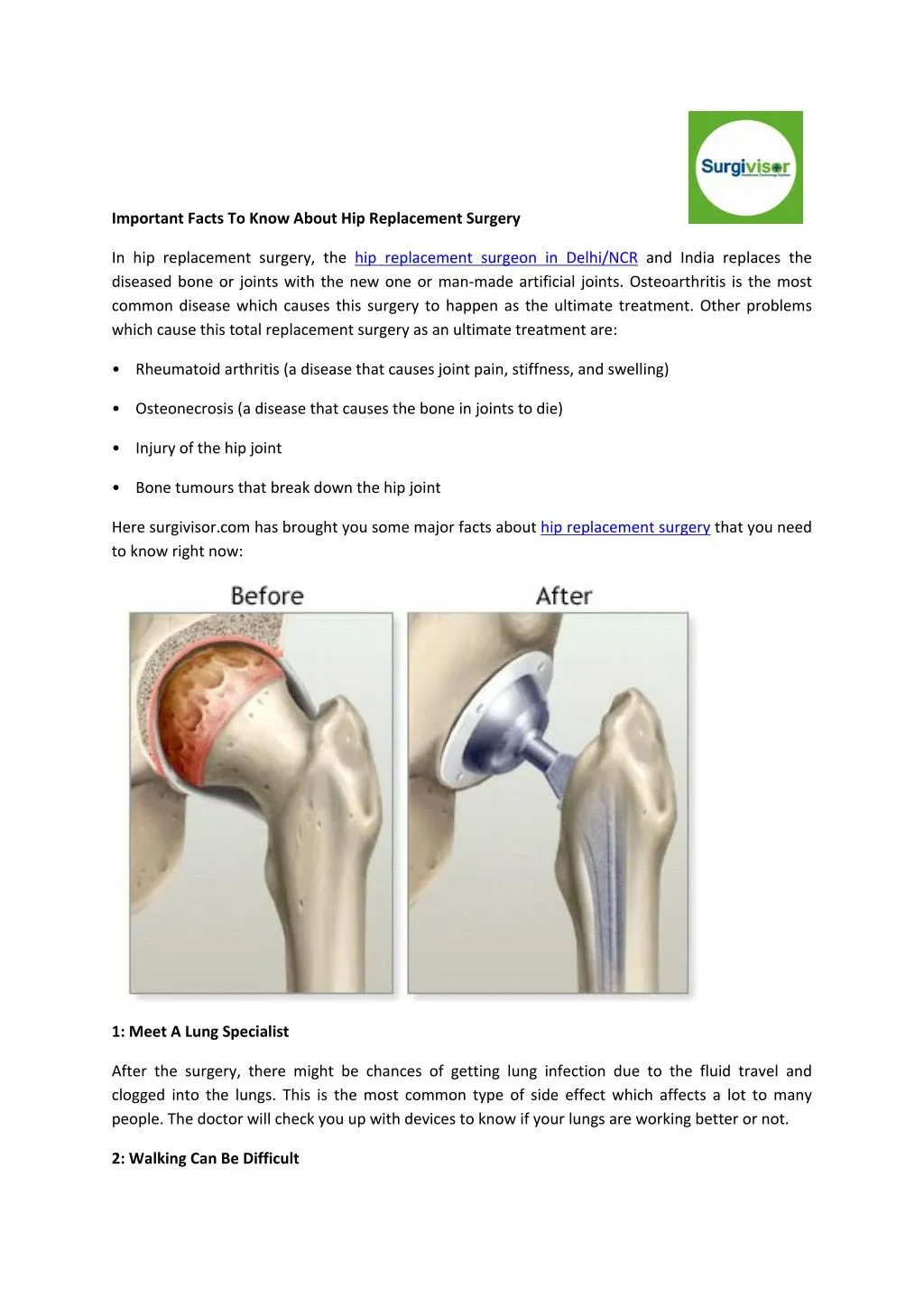 PPT - Important Facts To Know About Hip Replacement Surgery PowerPoint ...