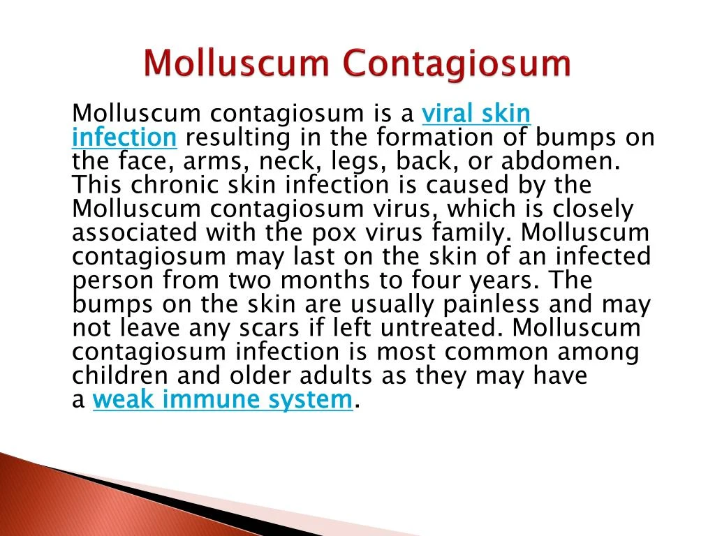 PPT - Molluscum Contagiosum: Symptoms, Causes, Diagnosis, Treatment and ...