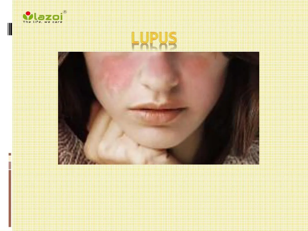 PPT - Lupus: Symptoms, Causes, Diagnosis and Treatment PowerPoint ... PPT - Lupus: Symptoms, Causes, Diagnosis and Treatment PowerPoint ...