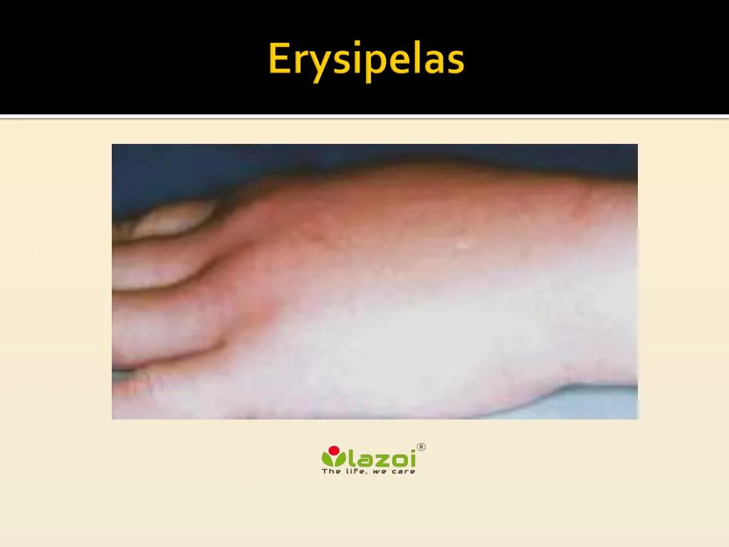PPT - Erysipelas: Symptoms, Causes, Diagnosis and Treatment PowerPoint ...