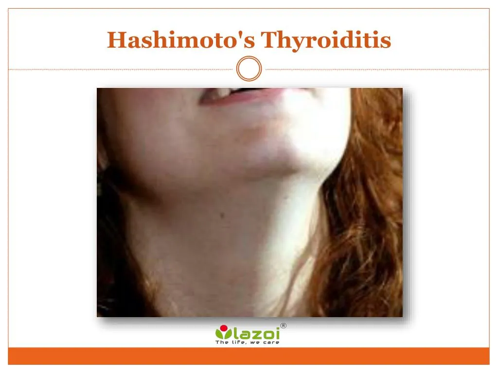 PPT - Hashimoto's thyroiditis: The most common form of thyroiditis ...