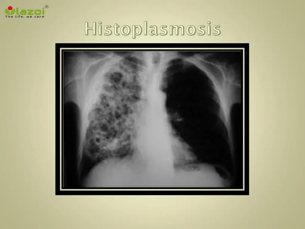 PPT - Histoplasmosis (fungal infection of the lungs): Symptoms, causes ...