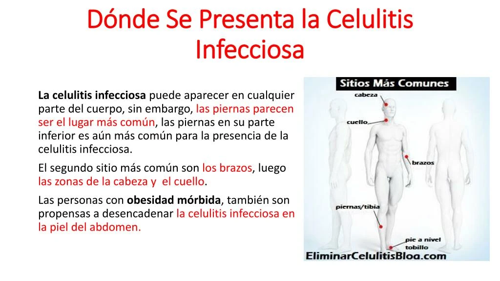 PPT - Celulitis Infecciosa: Causas, Síntomas y Tratamiento PowerPoint ...