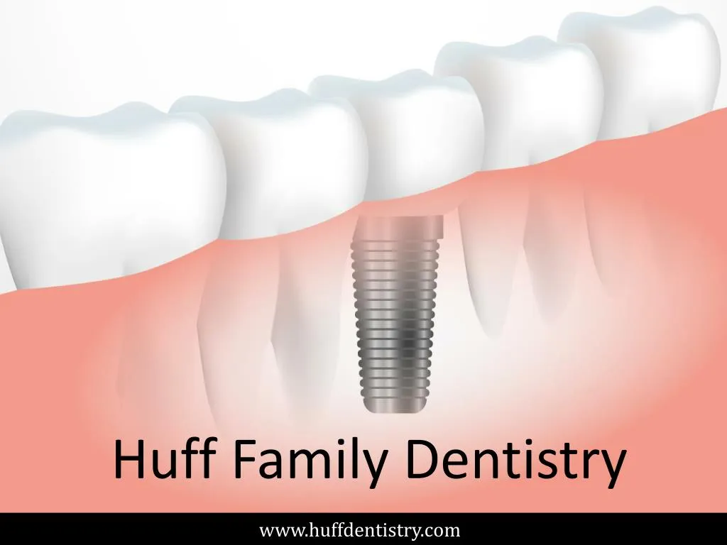 PPT - Lafayette Dental Implants PowerPoint Presentation, free download ...
