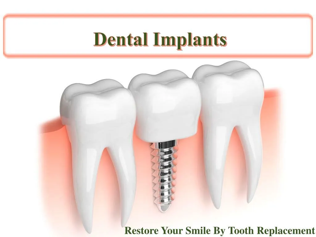 PPT - A Complete Guide to Dental Implants Treatment PowerPoint ...