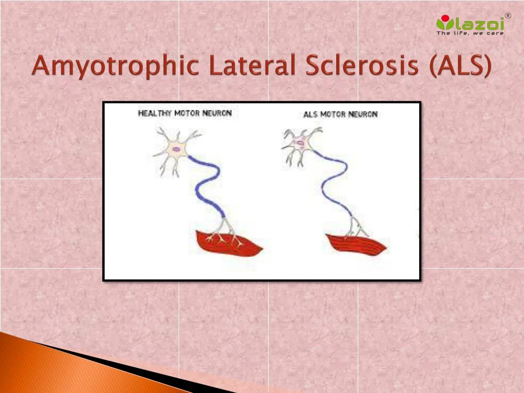 PPT - Amyotrophic Lateral Sclerosis (ALS): Symptoms, causes and ...