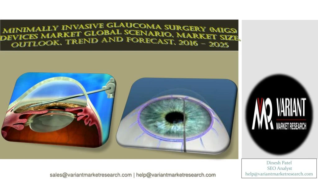 PPT - Minimally Invasive Glaucoma Surgery (MIGS) Devices Market ...