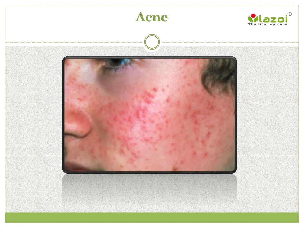 PPT - Acne PowerPoint Presentation, free download - ID:7928002