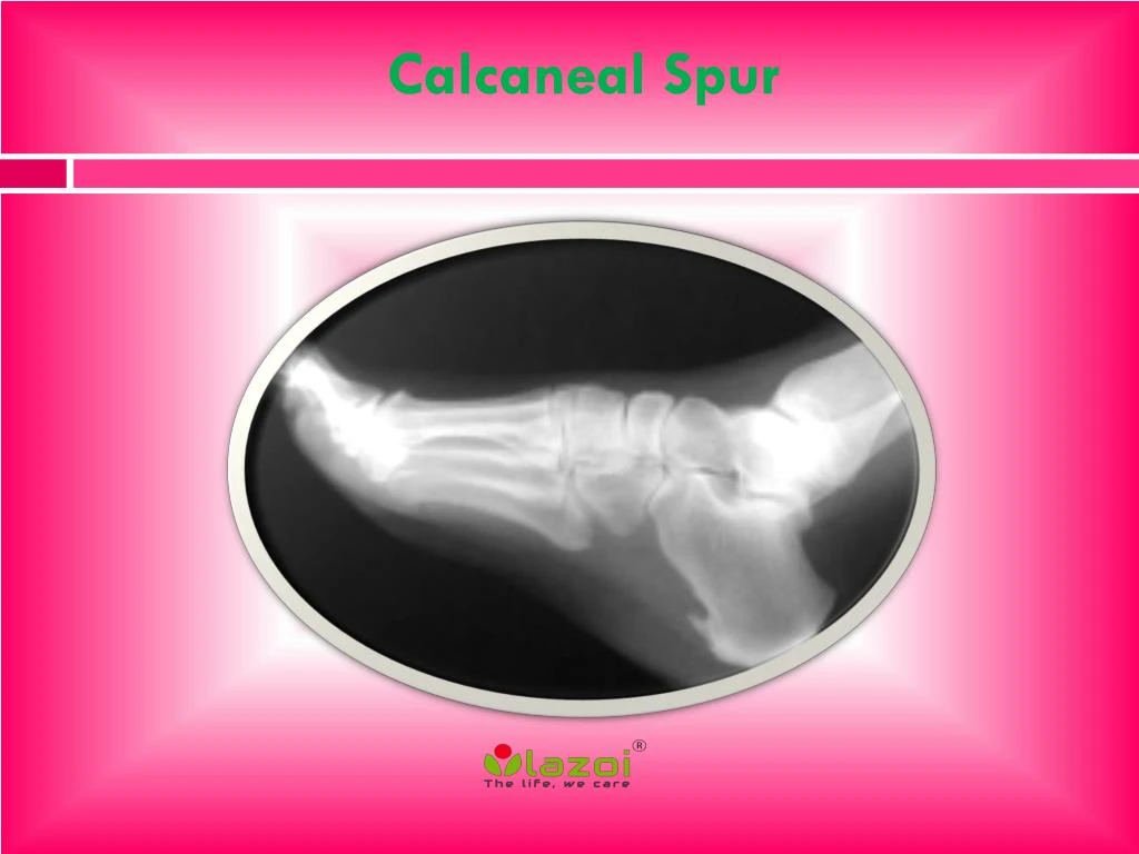PPT - Calcaneal Spur PowerPoint Presentation, free download - ID:7940136