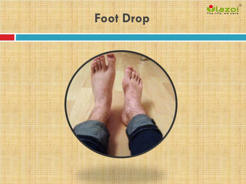 PPT - Foot Drop PowerPoint Presentation, free download - ID:7953305