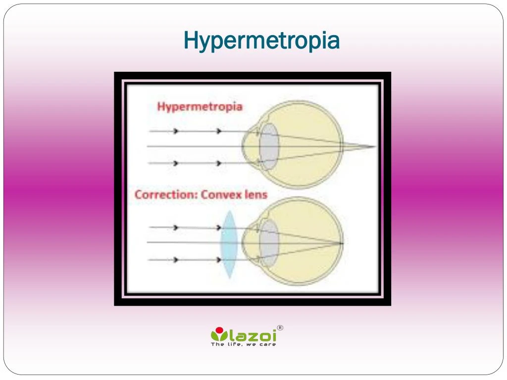 PPT - Hypermetropia: Causes, Symptoms, Daignosis, Prevention and ...
