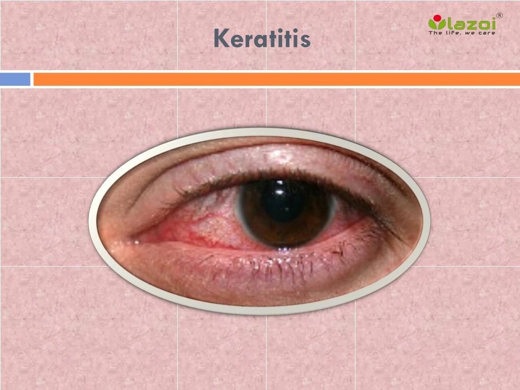 PPT - Keratitis: Causes, Symptoms, Daignosis, Prevention and Treatment ...