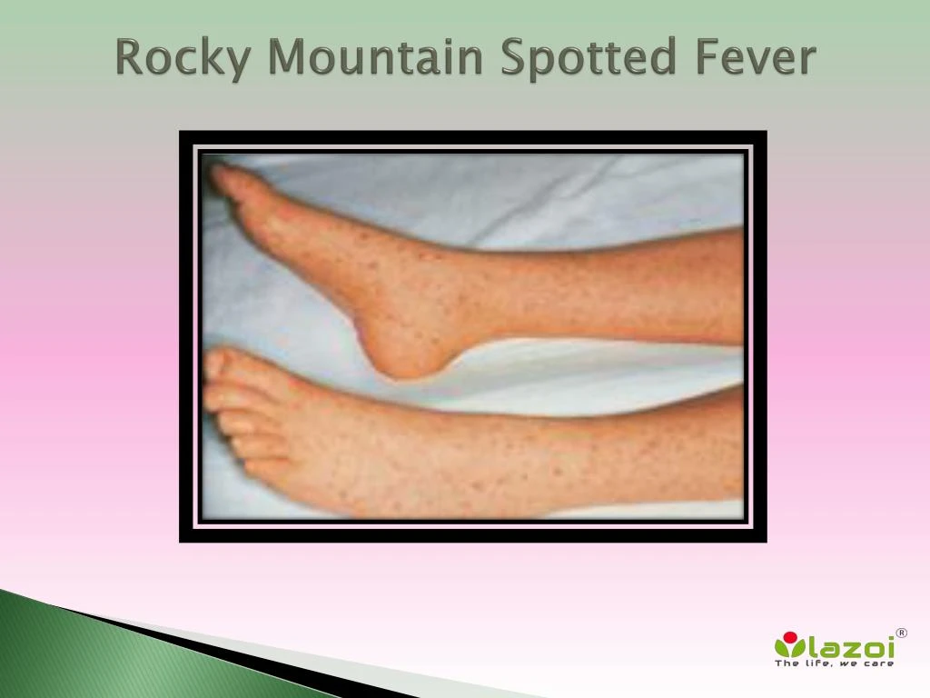 PPT - Rocky Mountain spotted fever: Causes, Symptoms, Daignosis ...