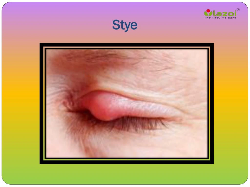 PPT - Stye: Causes, Symptoms, Daignosis, Prevention and Treatment ...