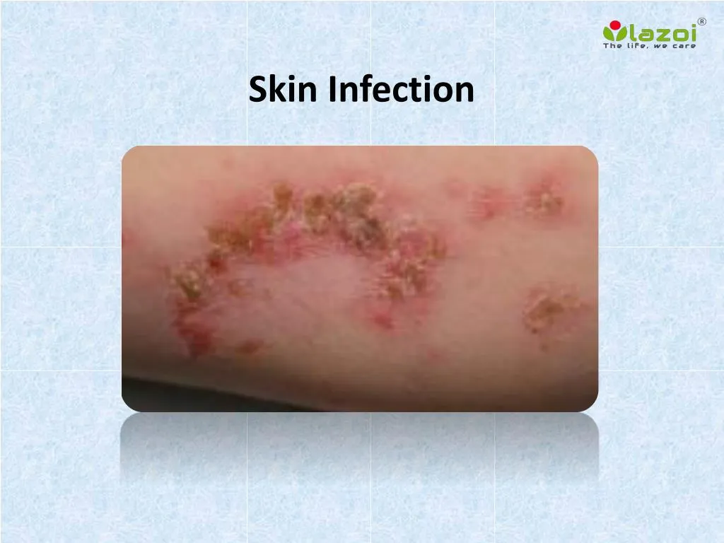 PPT - Skin Infection : Causes, Symptoms, Treatment, Prevention ...