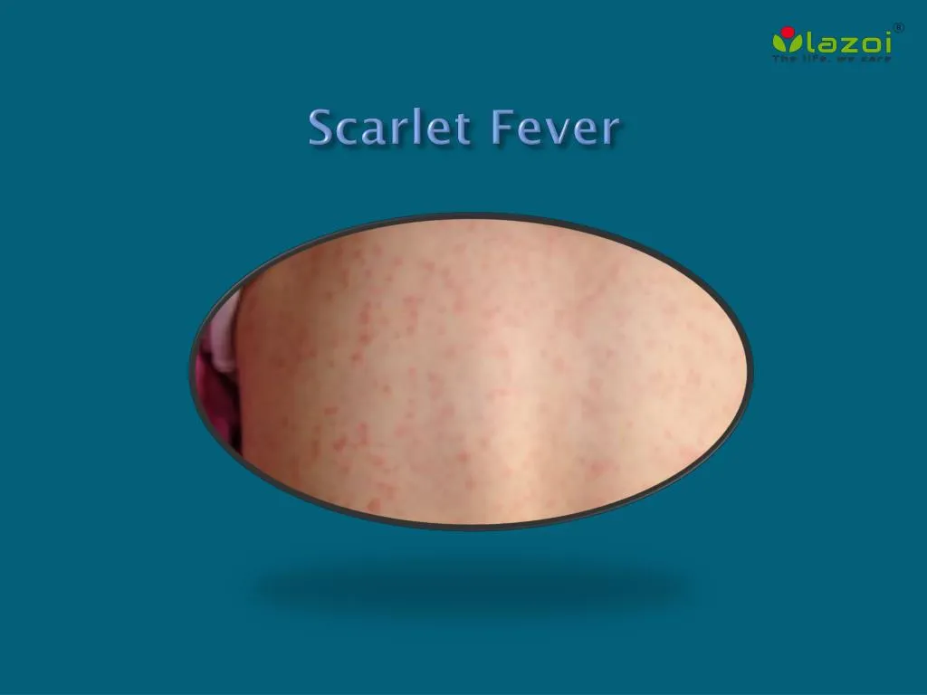 PPT - Scarlet Fever: Causes, Symptoms, Treatment and Prevention ...