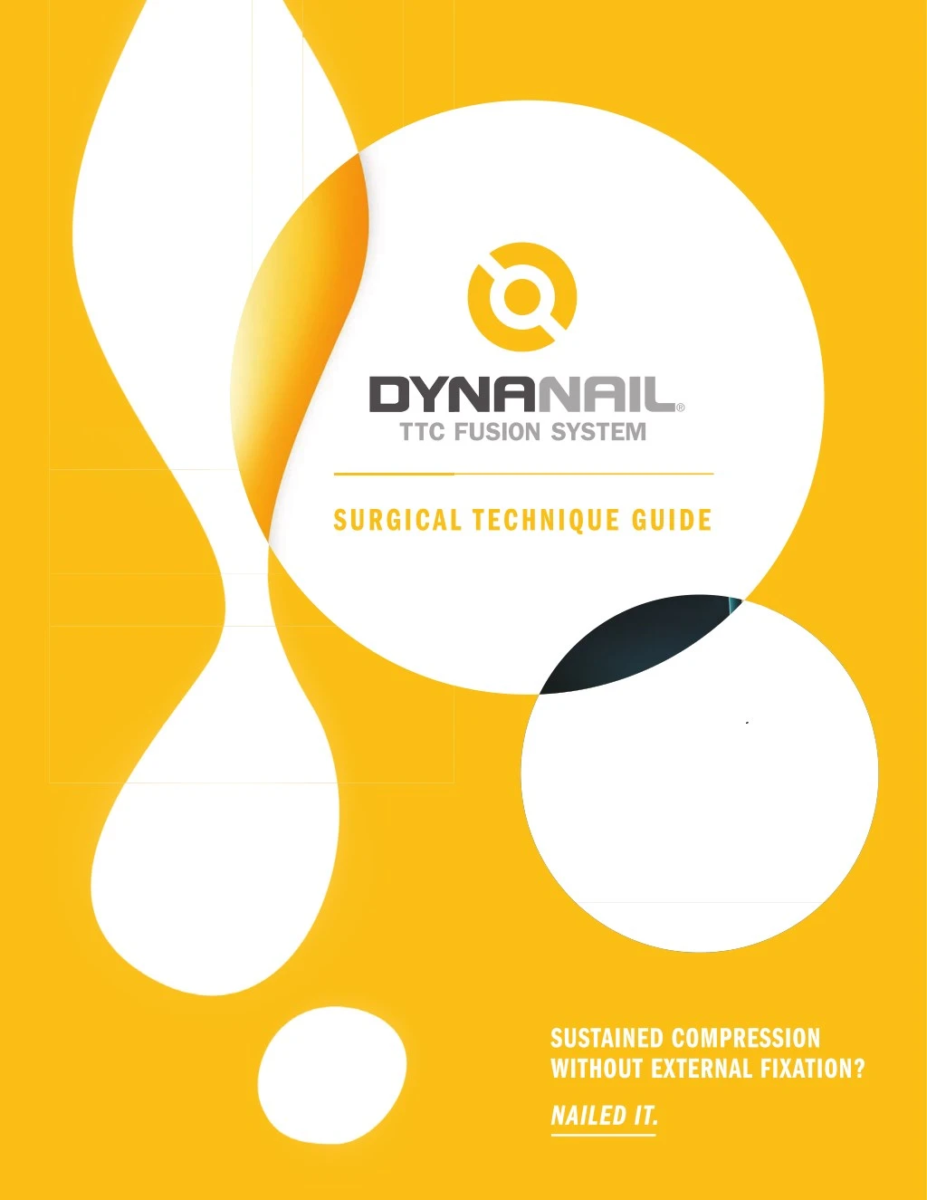 PPT - DynaNail® TTC Fusion System– Surgical Technique Guide PowerPoint ...