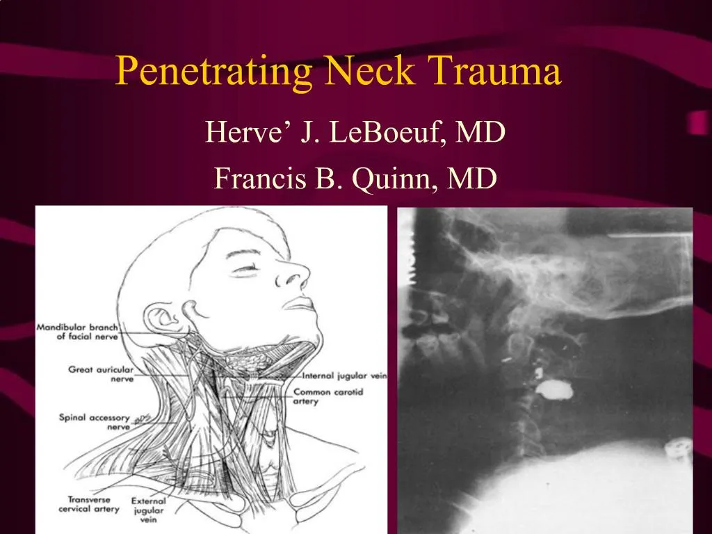 PPT - Penetrating Neck Trauma PowerPoint Presentation, free download ...