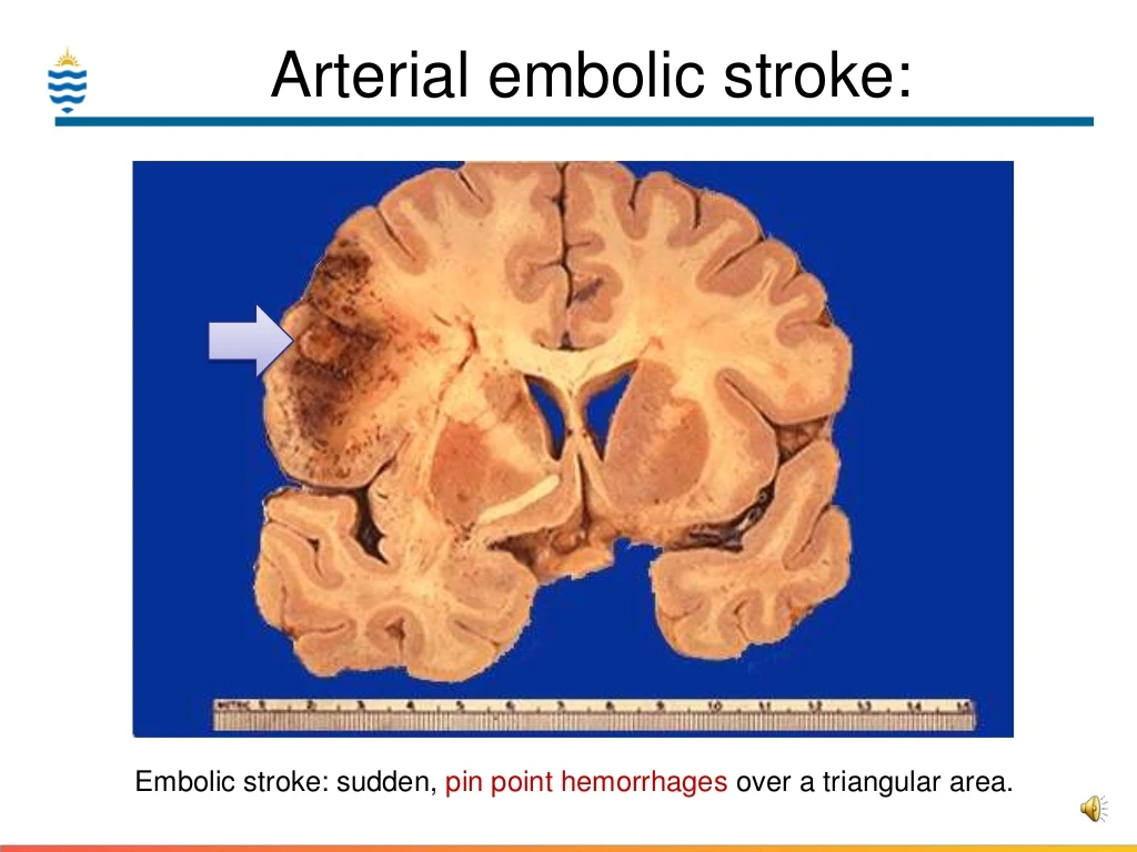 PPT - Pathology of Stroke & CVA PowerPoint Presentation - ID:8201896