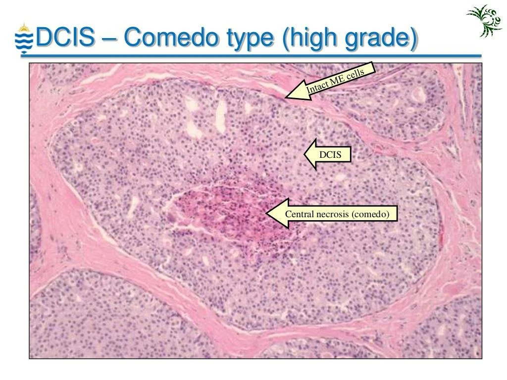 PPT - Breast Pathology Lecture - 2013 PowerPoint Presentation - ID:8201940