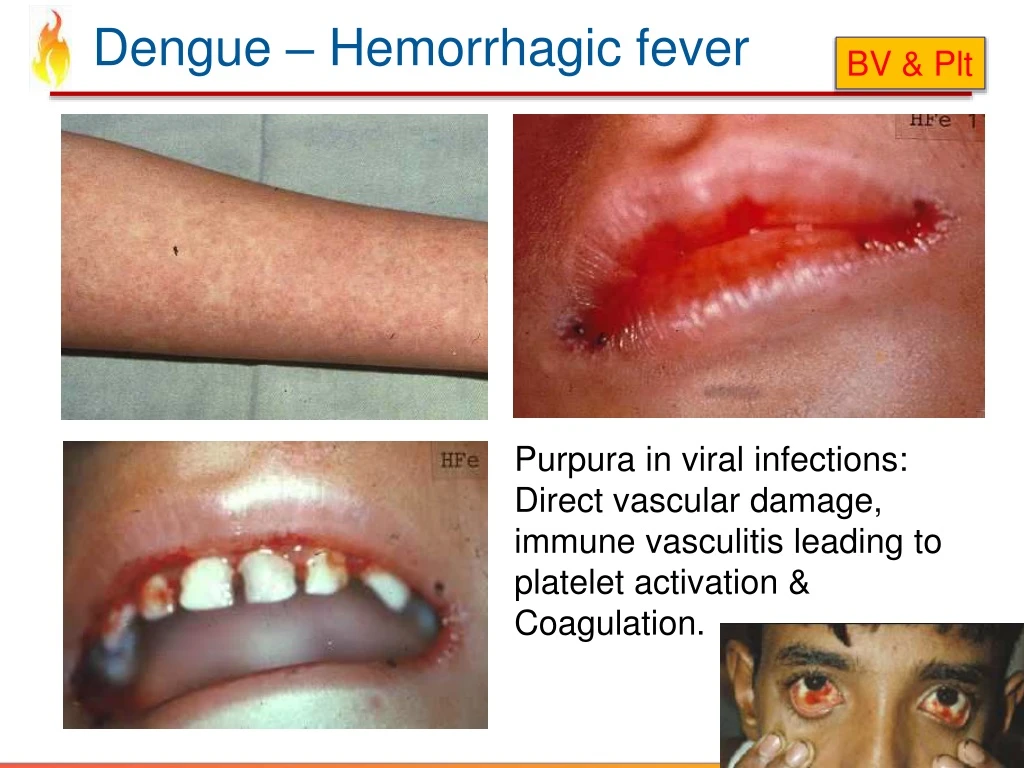 PPT - Haematology for Dental Students - Bleeding Disorders PowerPoint ...