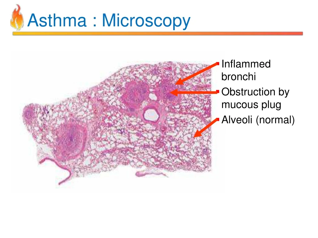 PPT - Pathology of COPD PowerPoint Presentation - ID:8201945