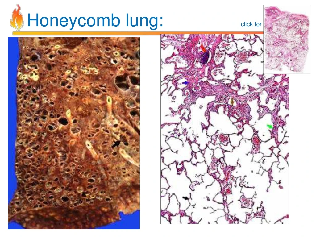 PPT - Pathology of COPD PowerPoint Presentation - ID:8201945