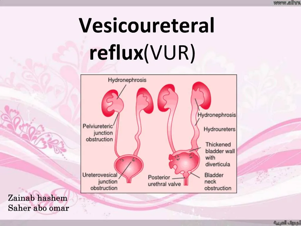 PPT - Vesicoureteral reflux VUR PowerPoint Presentation, free download ...
