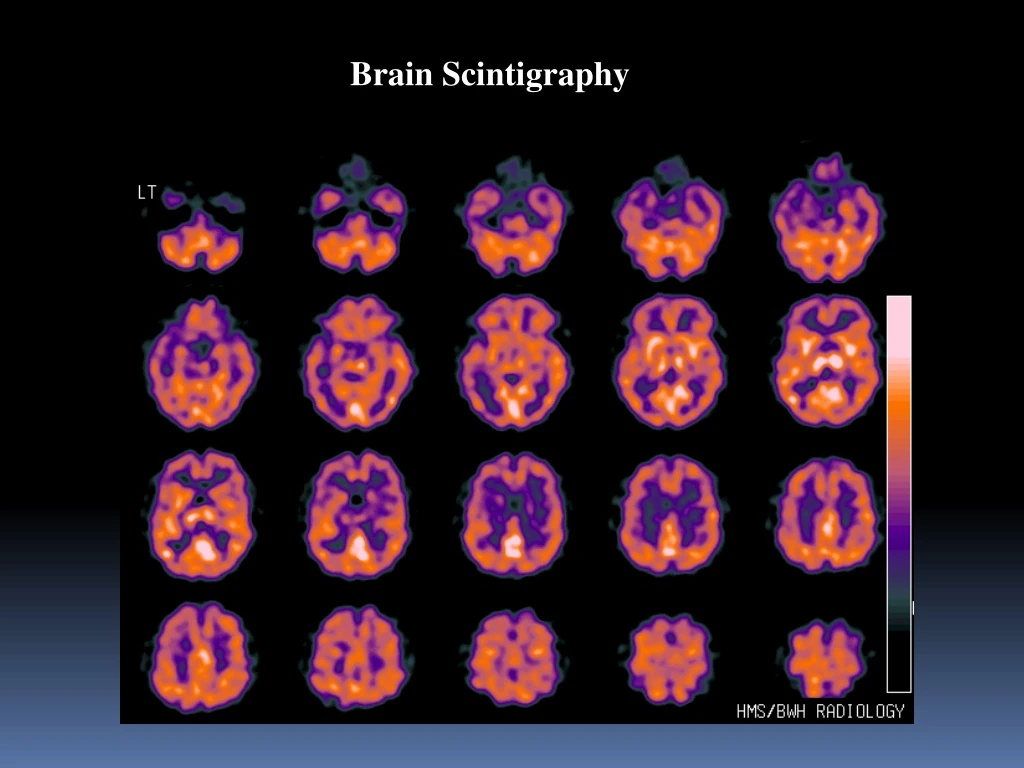PPT - Brain Scintigraphy PowerPoint Presentation, free download - ID ...